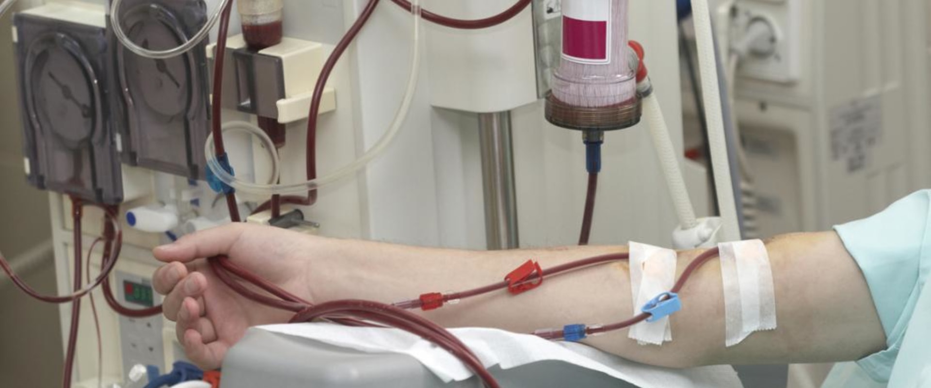 Diabetic Nephropathy Pathophysiology: A Clear Definition, Its Stages ...